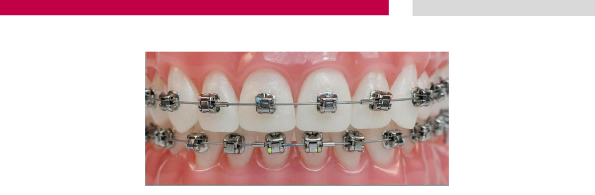 Aparelho Autoligado - Dra Mariana - Dentista em Campinas